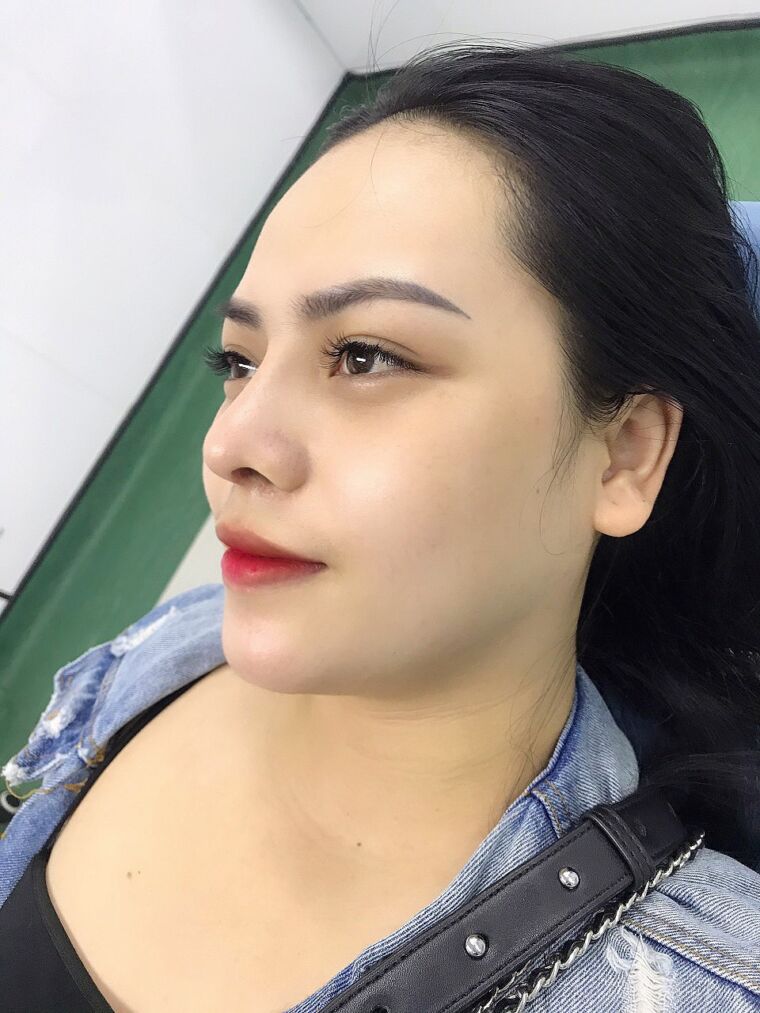 Viện thẩm mỹ Happy Nose-Dr.Đức Happy thẩm mỹ nâng mũi vi phẫu